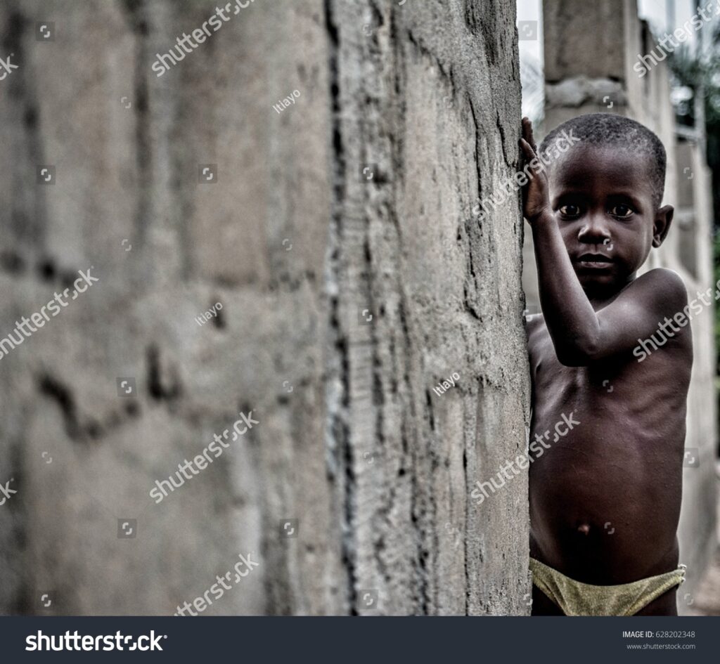 Difference Between Kwashiorkor And Marasmus - 88Guru